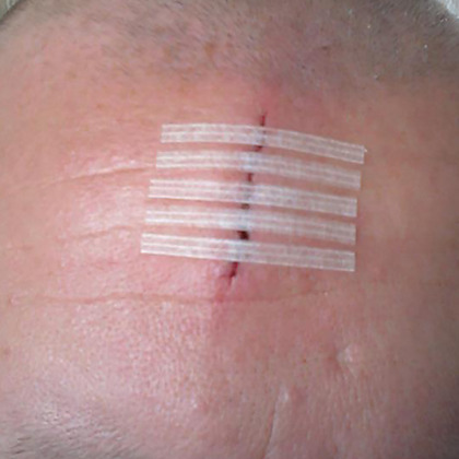 Adhesive Dressings | Wound Care | First Aid Online